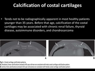 CT scan of Rib pathologies | PPTX