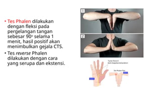 Carpal Tunnel Syndrome adalah gangguan saraf yang memengaruhi jari dan ...