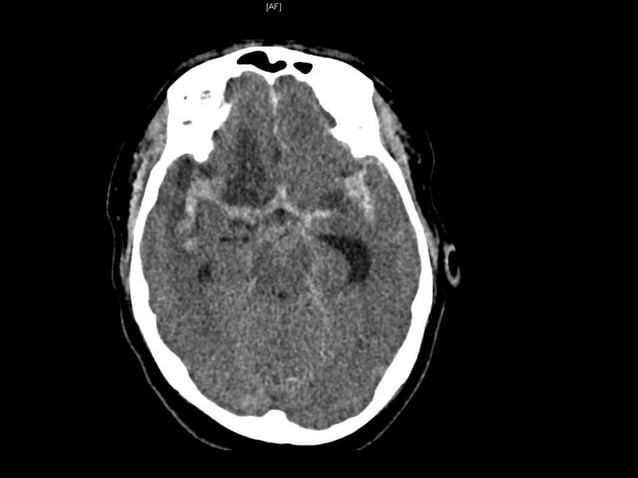 Ct sah answer | PPTX