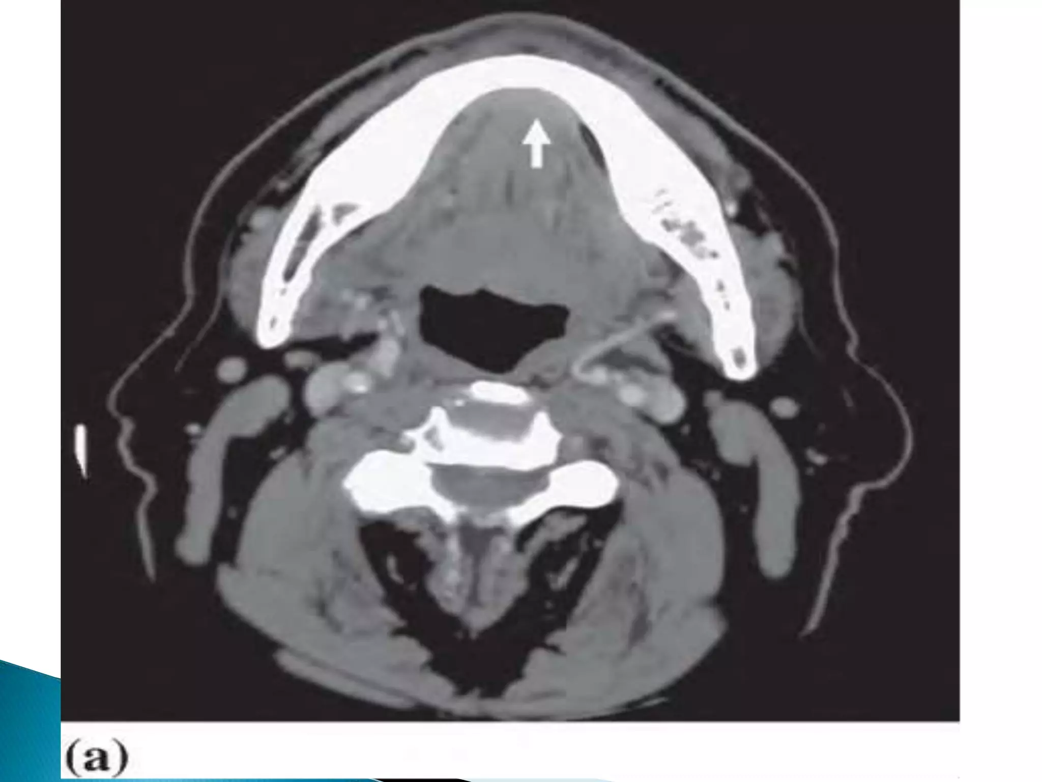 Ct scan | PPTX