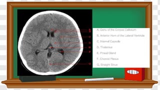 CT SCAN | PPT