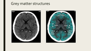 Ct scan agp | PPTX