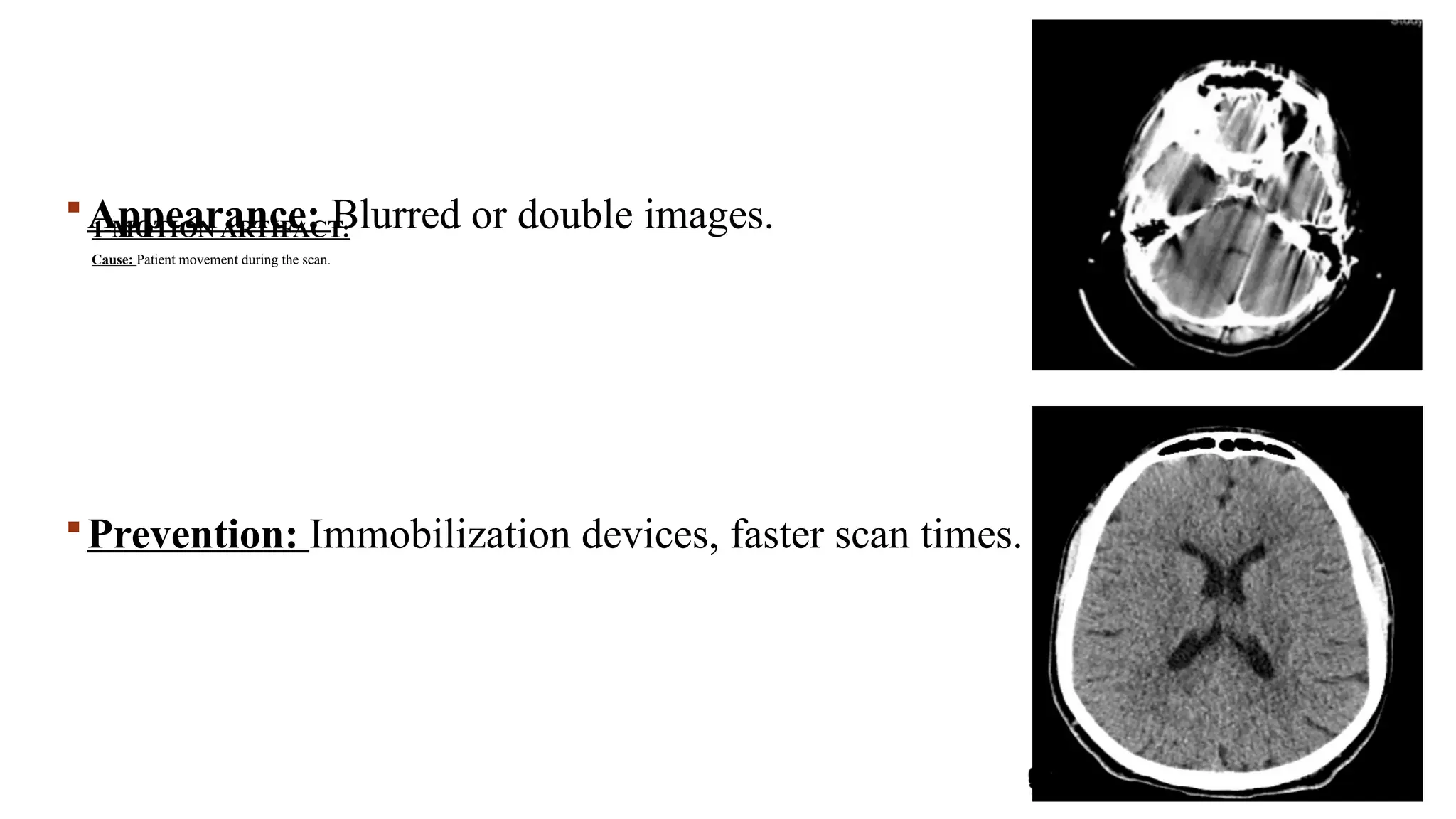 CT-Scan Artifacts and their Types .pptx