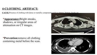 CT-Scan Artifacts and their Types .pptx