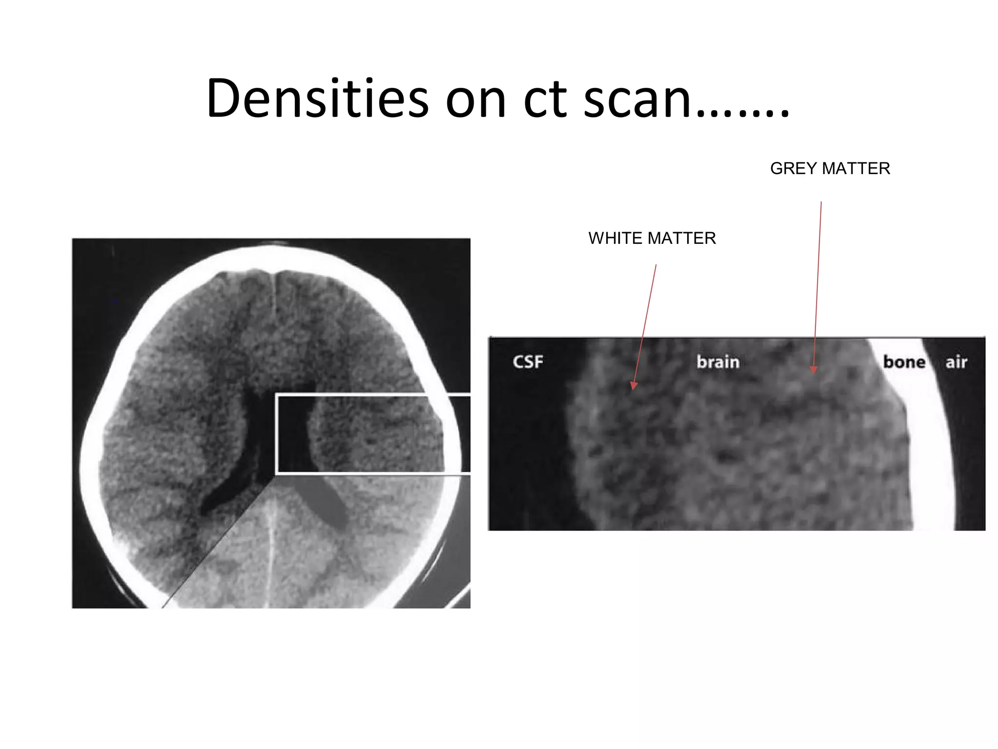 CT Scan Head basics | PPT