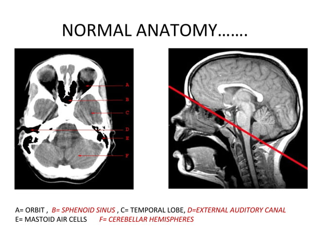 CT Scan Head basics
