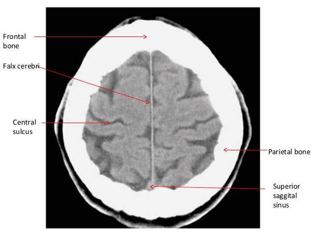 CT Scan Head basics