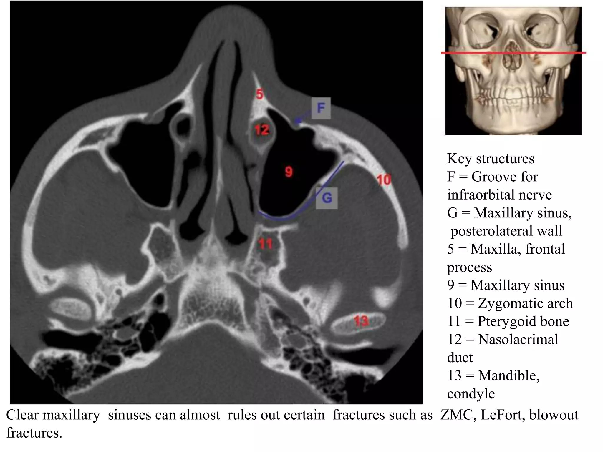 Ct scan and its interpretation in omfs | PPTX