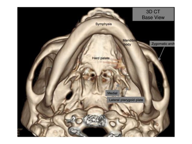 Ct scan and its interpretation in omfs | PPTX | Death, Injury, or ...
