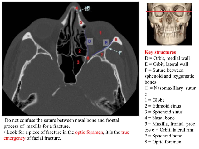 Ct scan and its interpretation in omfs | PPTX | Death, Injury, or ...