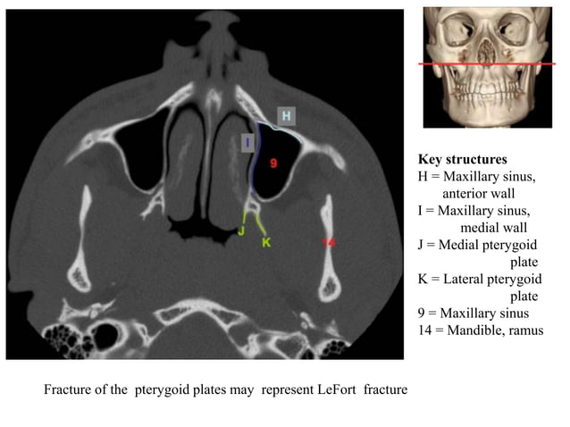 Ct scan and its interpretation in omfs | PPTX | Death, Injury, or ...