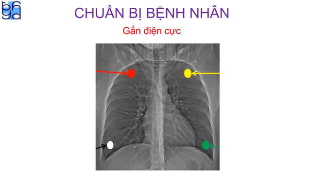 CHUP CAT LOP VI TINH DONG MACH VANH.pptx