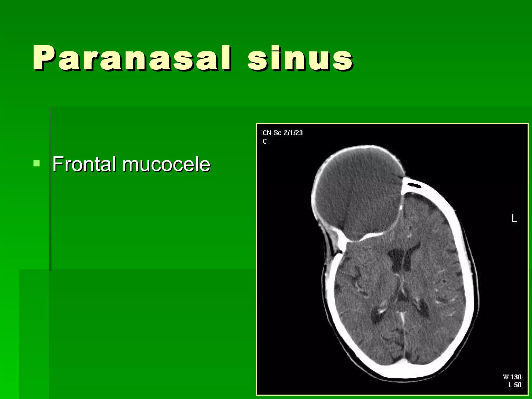 Ct scan eye slide presentation | PPT | Ear, Nose and Throat Conditions ...