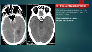 Ct scan in head and spine injuries | PPTX
