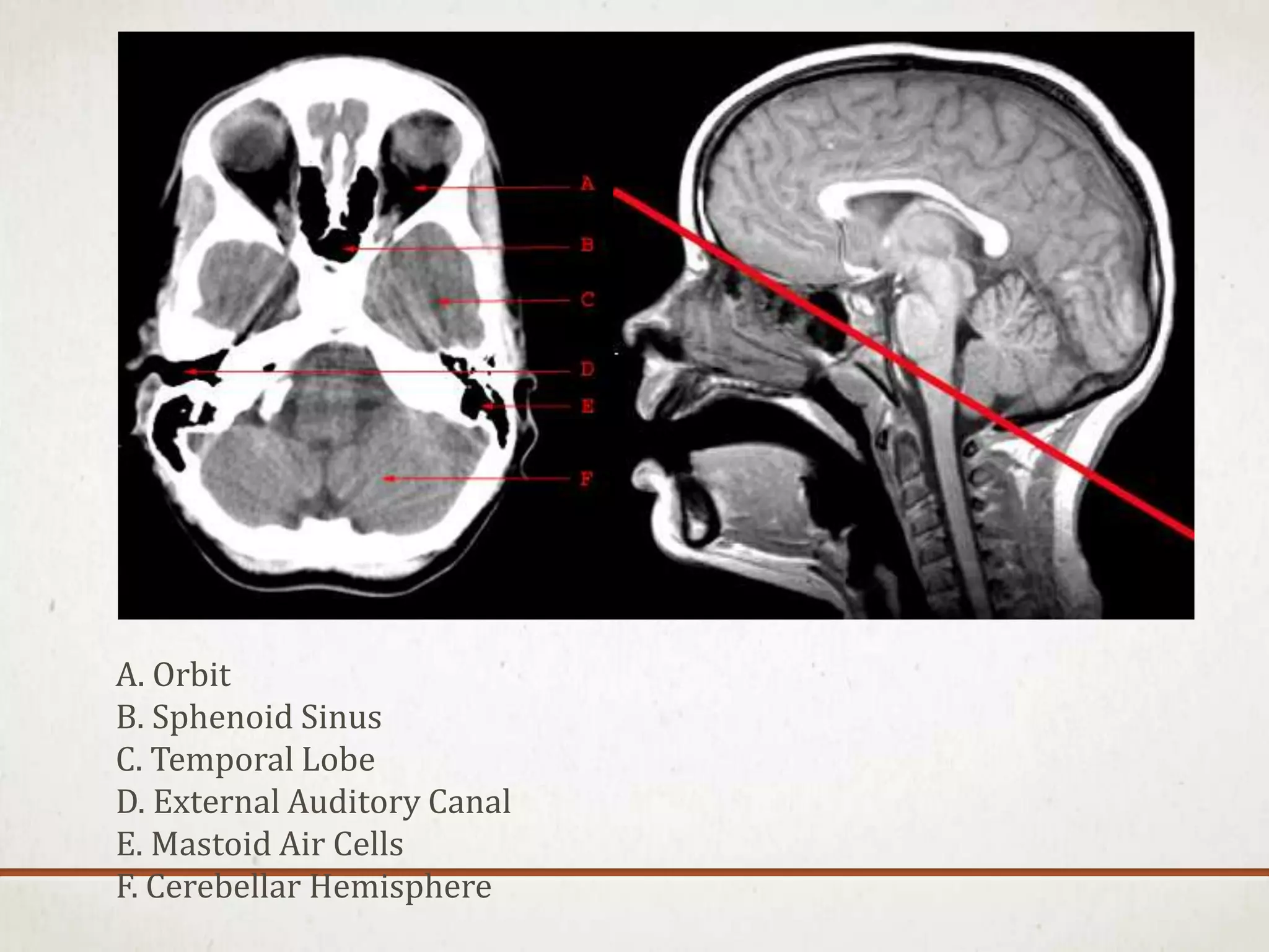 BRAIN CT SCAN | PPTX
