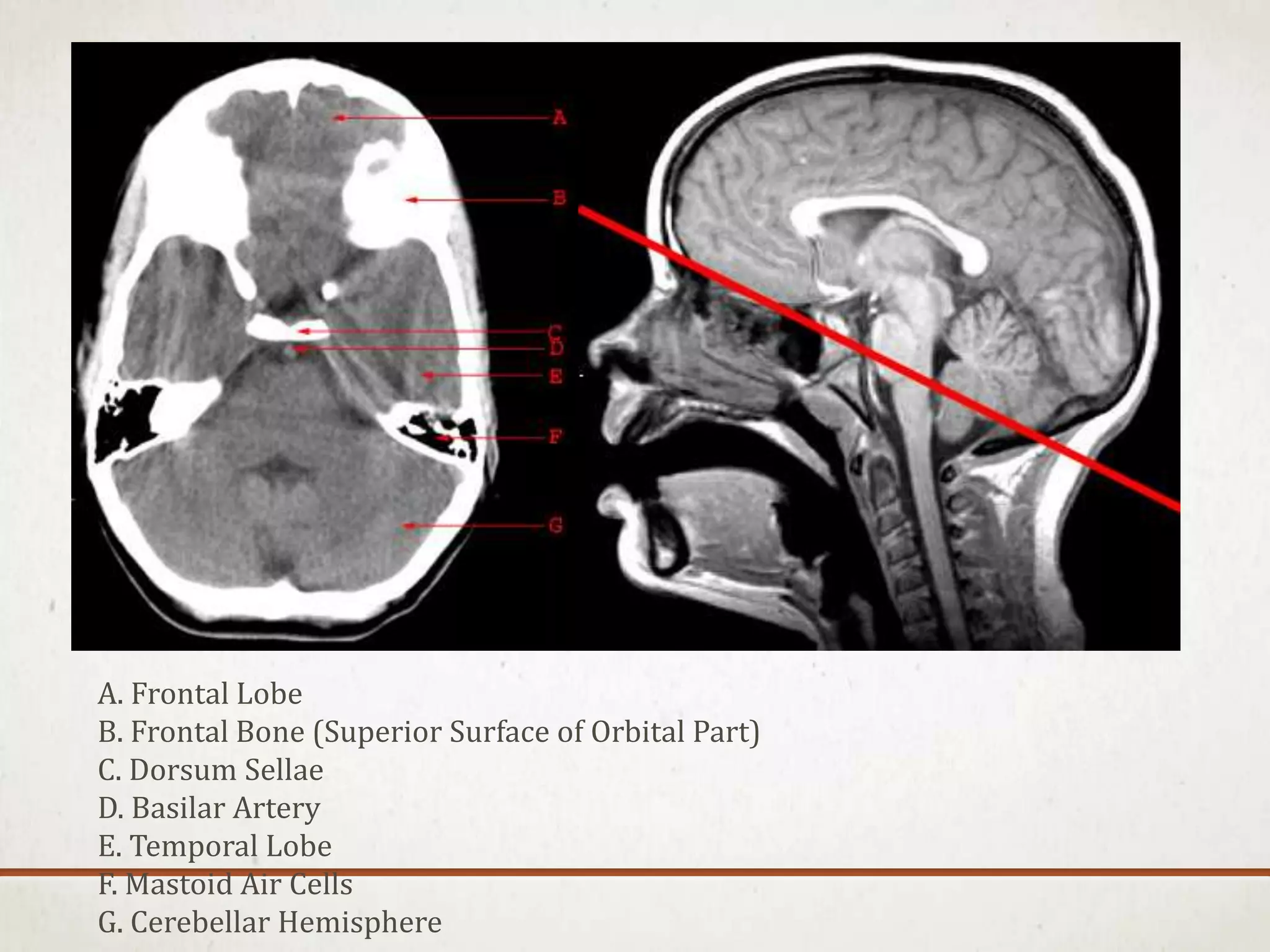 BRAIN CT SCAN | PPTX