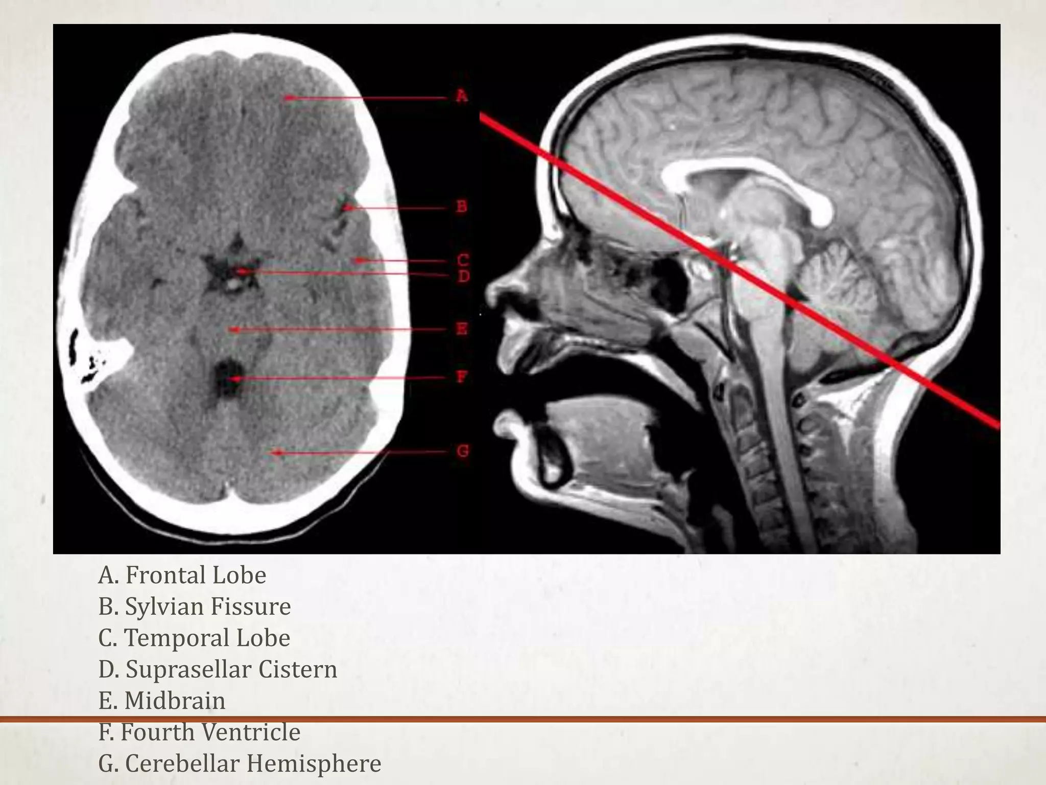 BRAIN CT SCAN | PPTX