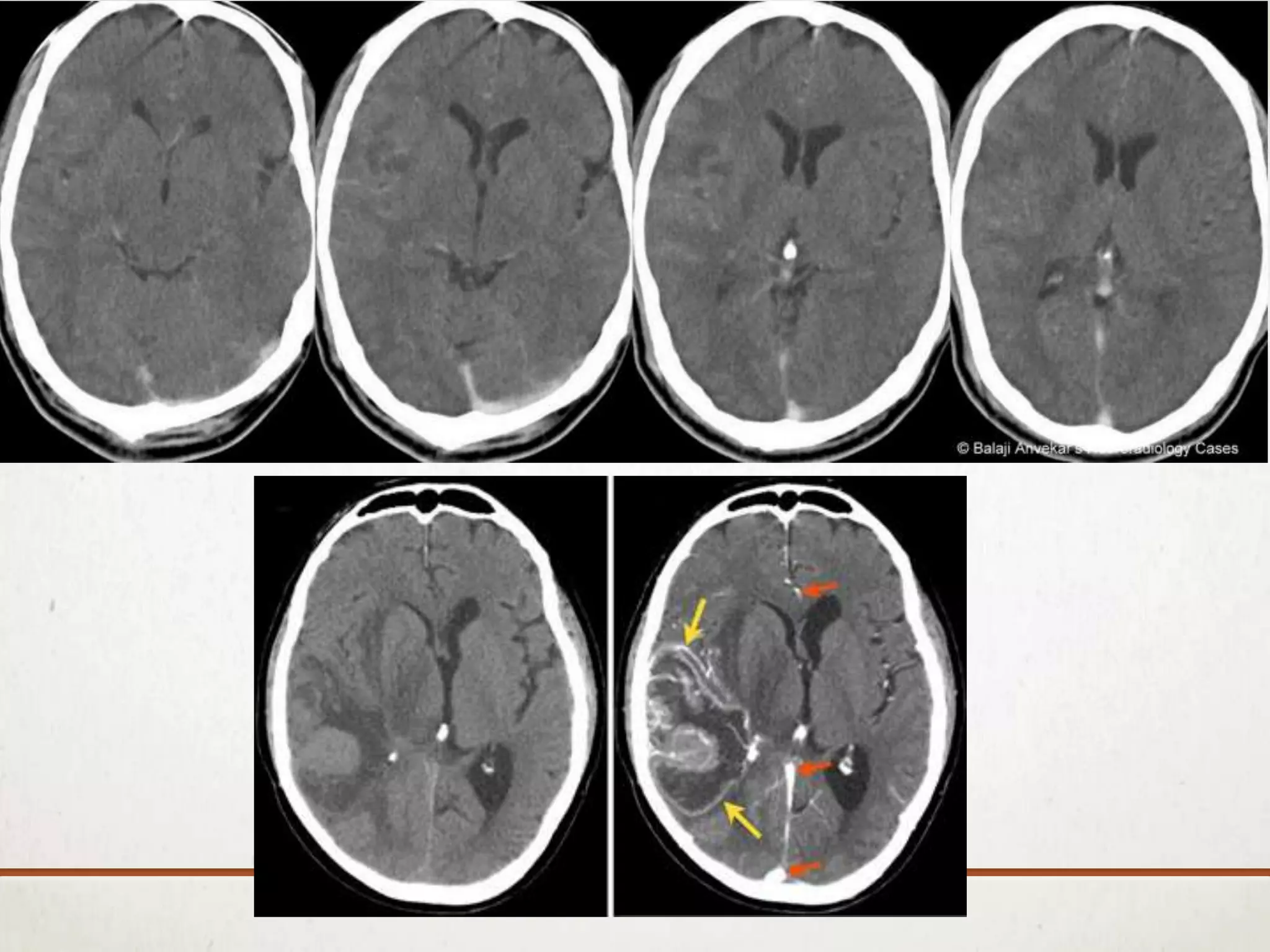 BRAIN CT SCAN | PPTX