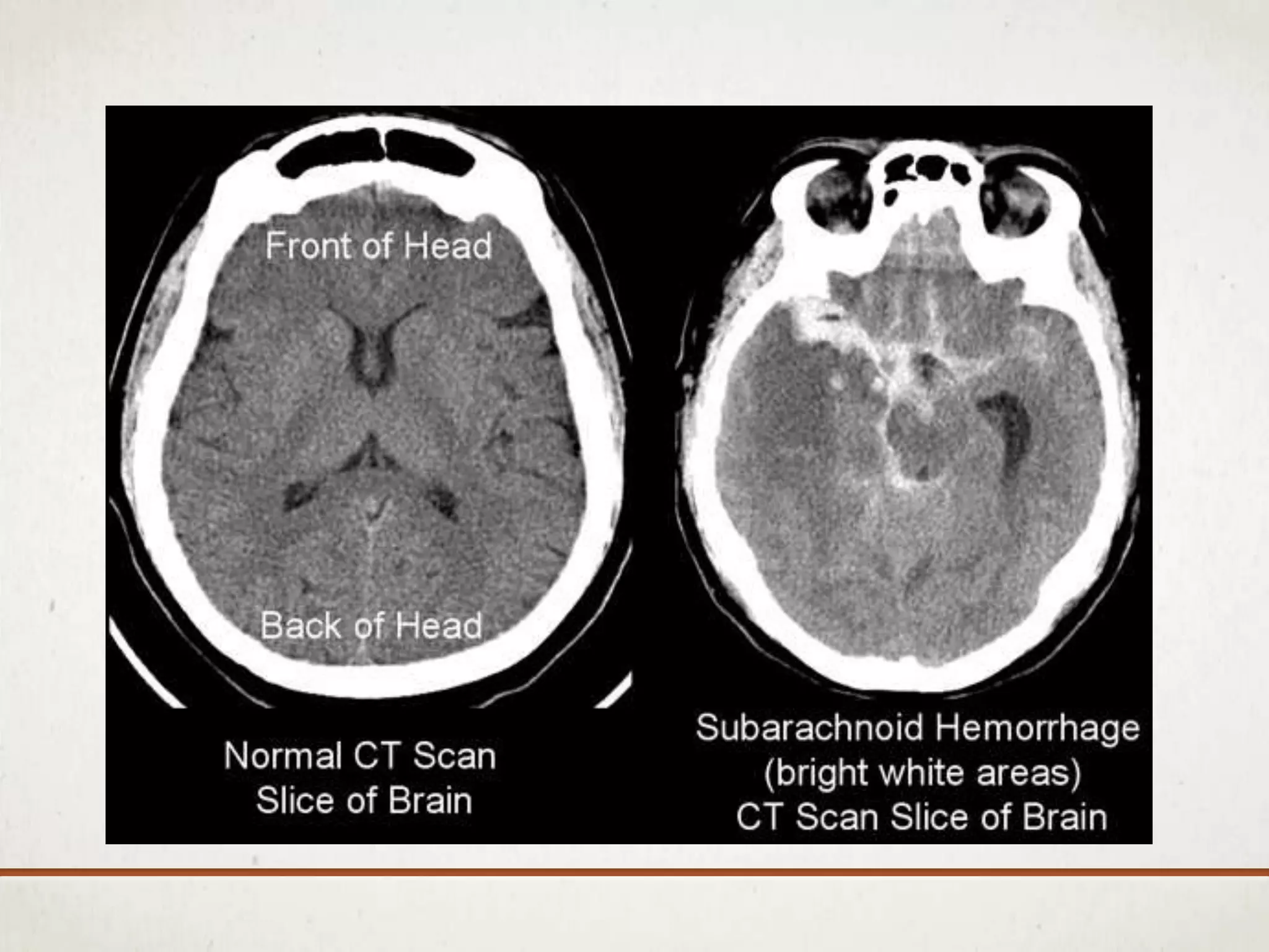 BRAIN CT SCAN | PPTX