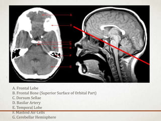 BRAIN CT SCAN | PPTX