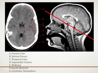 BRAIN CT SCAN | PPTX