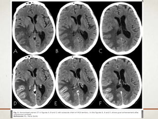 BRAIN CT SCAN | PPTX