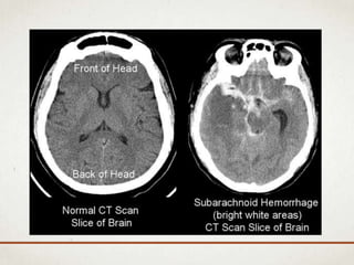 BRAIN CT SCAN | PPTX