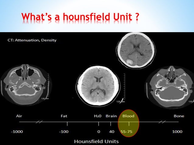 CT scan of the brain in stroke patients | PPTX | Brain and Nervous ...