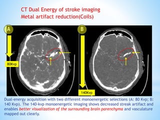 CT scan of the brain in stroke patients | PPTX