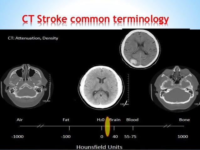 CT scan of the brain in stroke patients