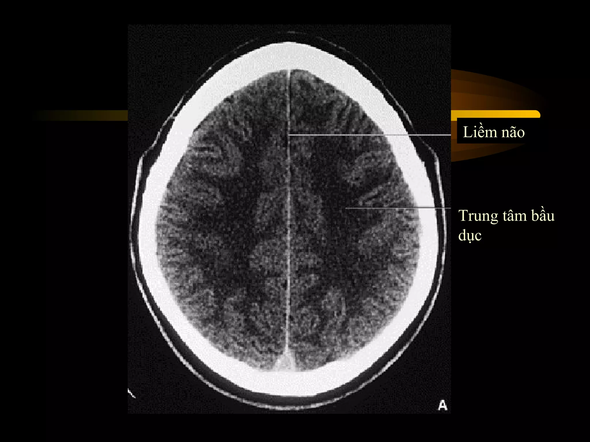 CT scan trong tai biến mạch máu não | PPT