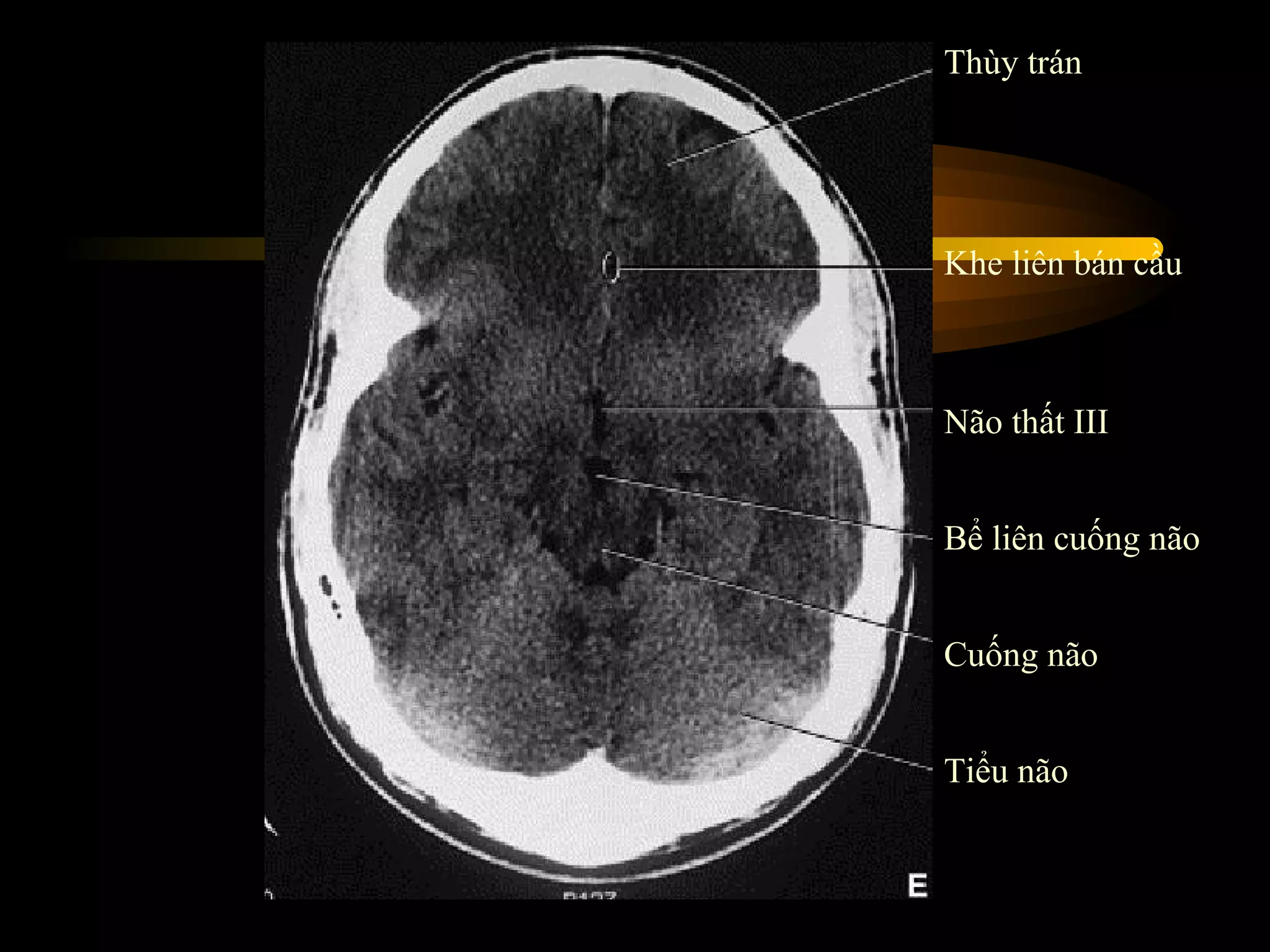 CT scan trong tai biến mạch máu não | PPT