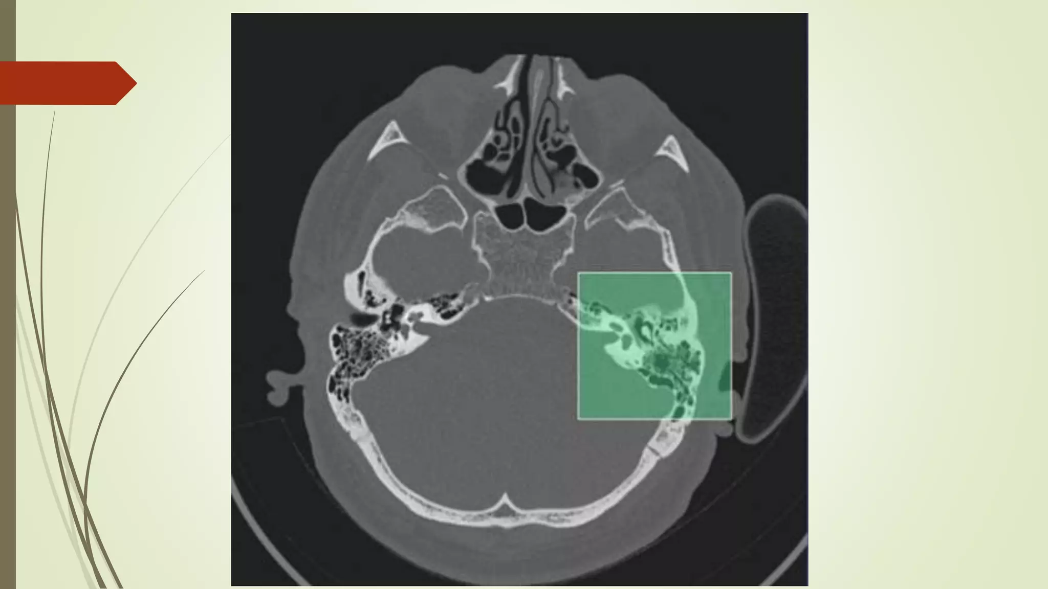 Ct scan temporal bone Dr Zeeshan Ahmad | PPTX