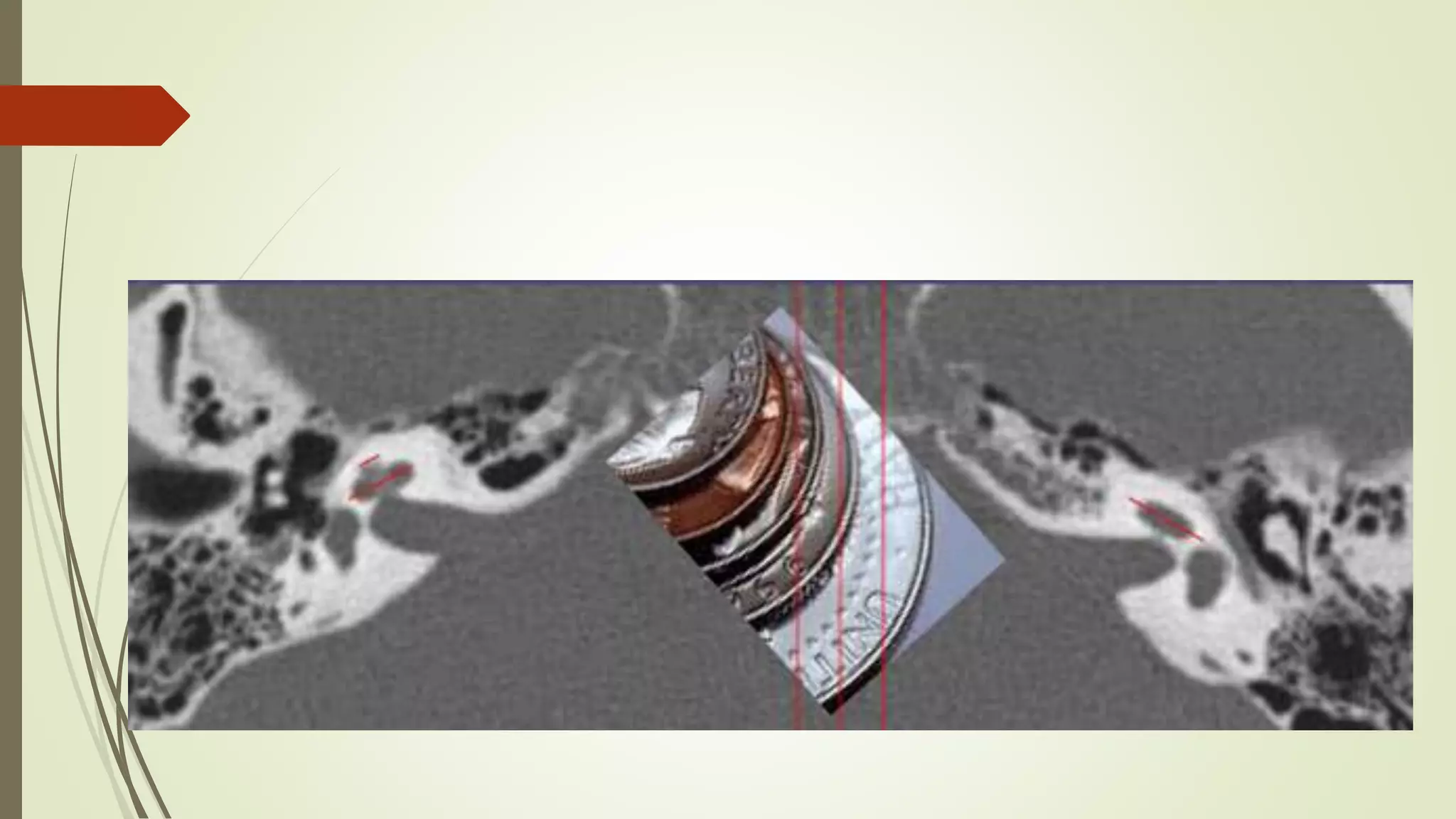 Ct scan temporal bone Dr Zeeshan Ahmad | PPTX