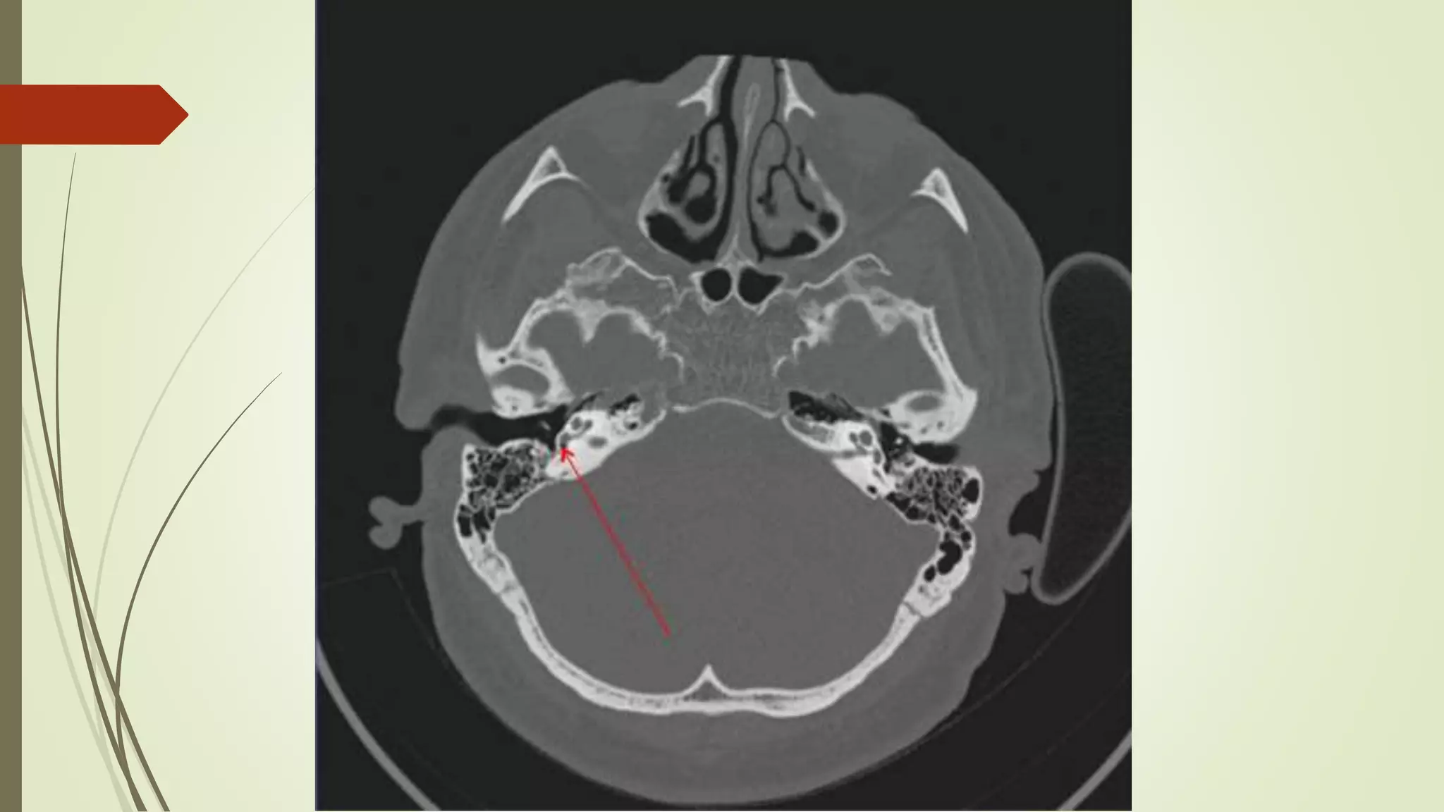 Ct scan temporal bone Dr Zeeshan Ahmad | PPTX