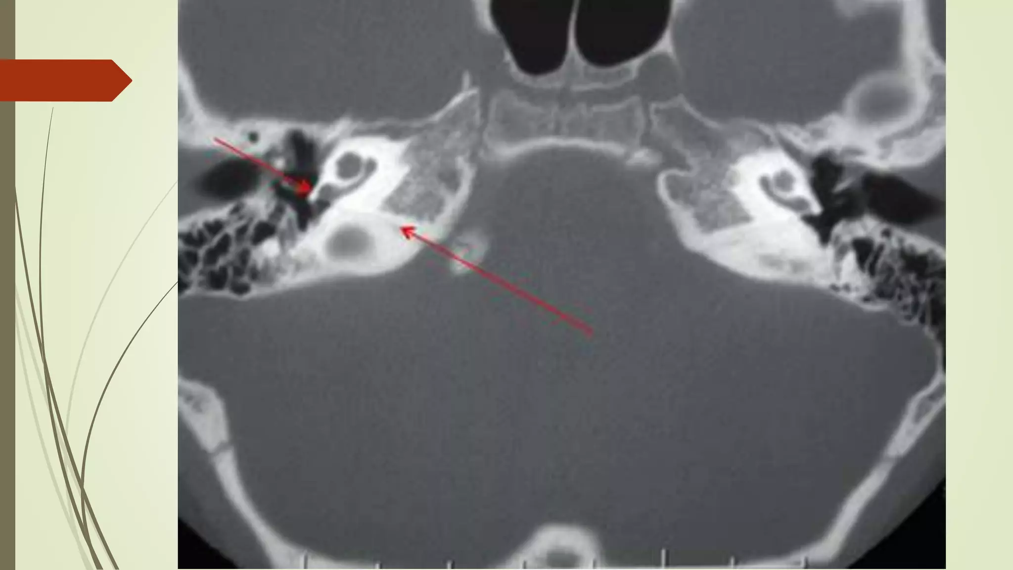 Ct scan temporal bone Dr Zeeshan Ahmad | PPTX