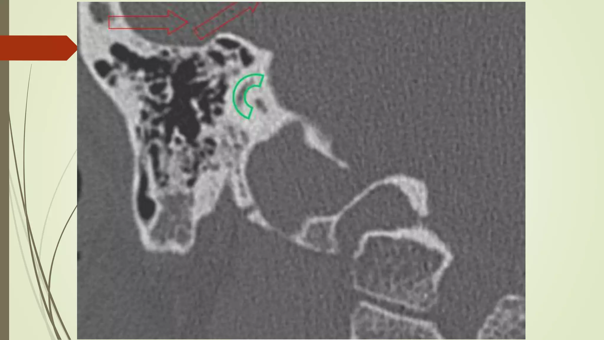 Ct scan temporal bone Dr Zeeshan Ahmad | PPTX