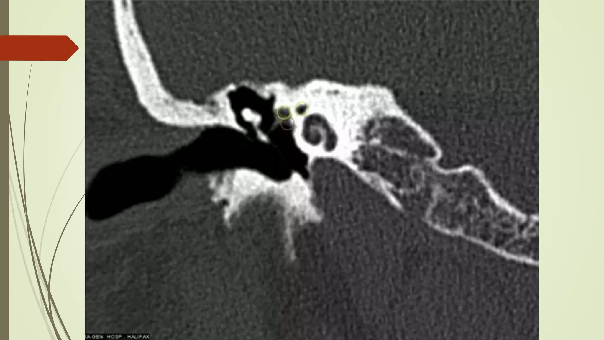 Ct scan temporal bone Dr Zeeshan Ahmad | PPTX