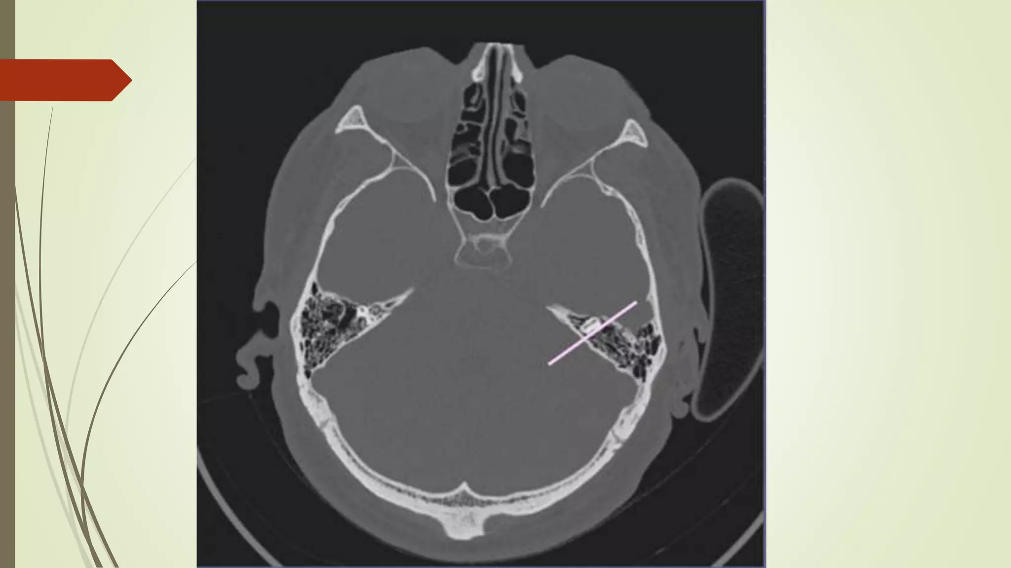 Ct scan temporal bone Dr Zeeshan Ahmad | PPTX