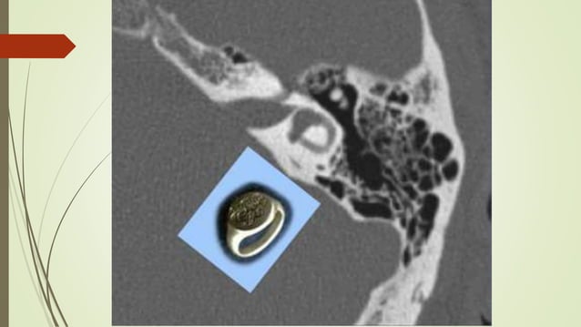 Ct scan temporal bone Dr Zeeshan Ahmad | PPTX