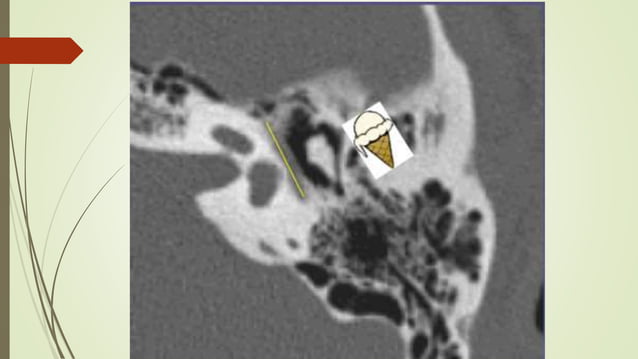 Ct scan temporal bone Dr Zeeshan Ahmad | PPTX