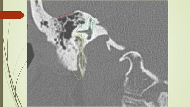 Ct scan temporal bone Dr Zeeshan Ahmad | PPTX