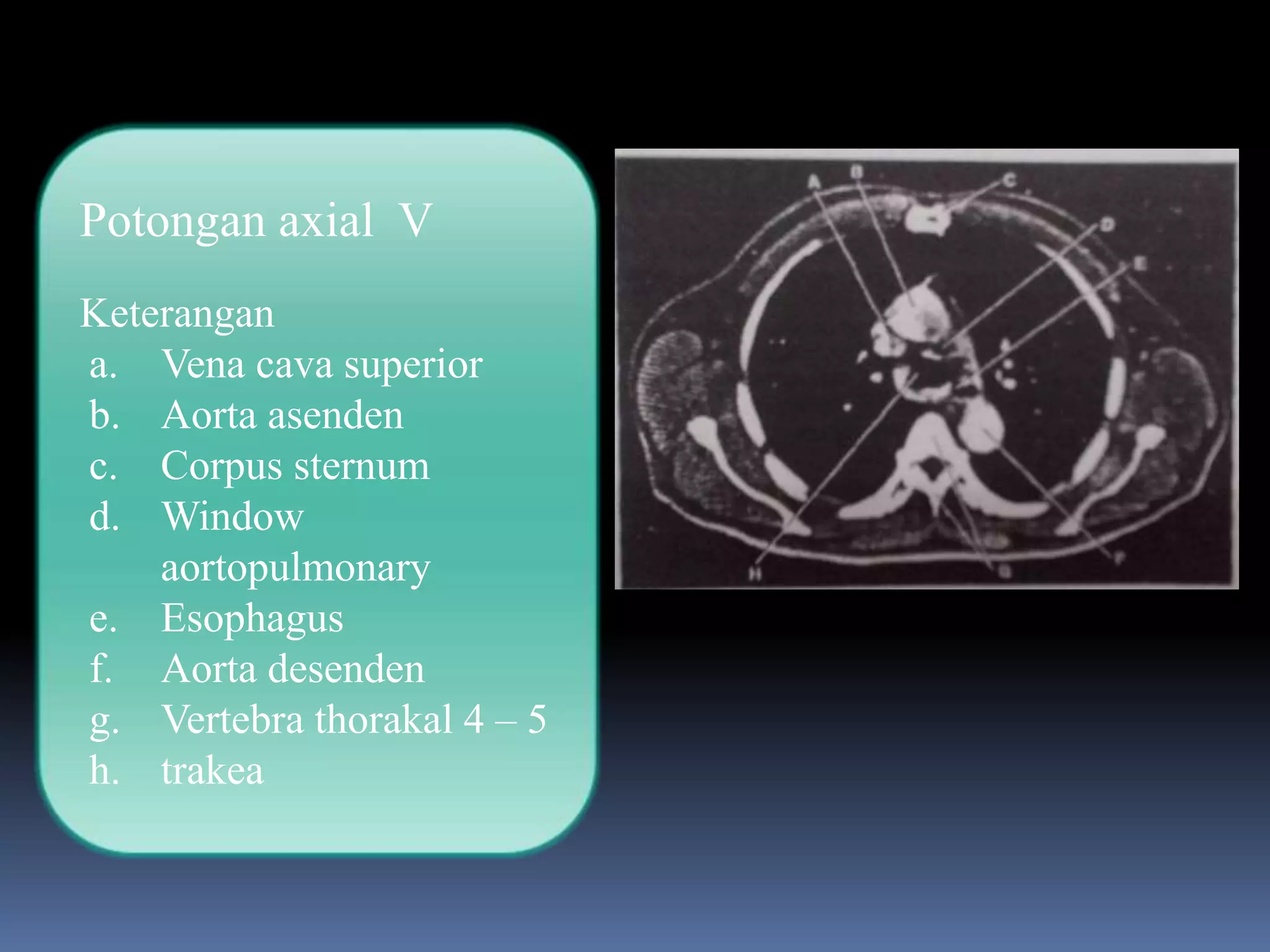 ppt Ct scan thorax pada klinis tumor hepar | PPTX