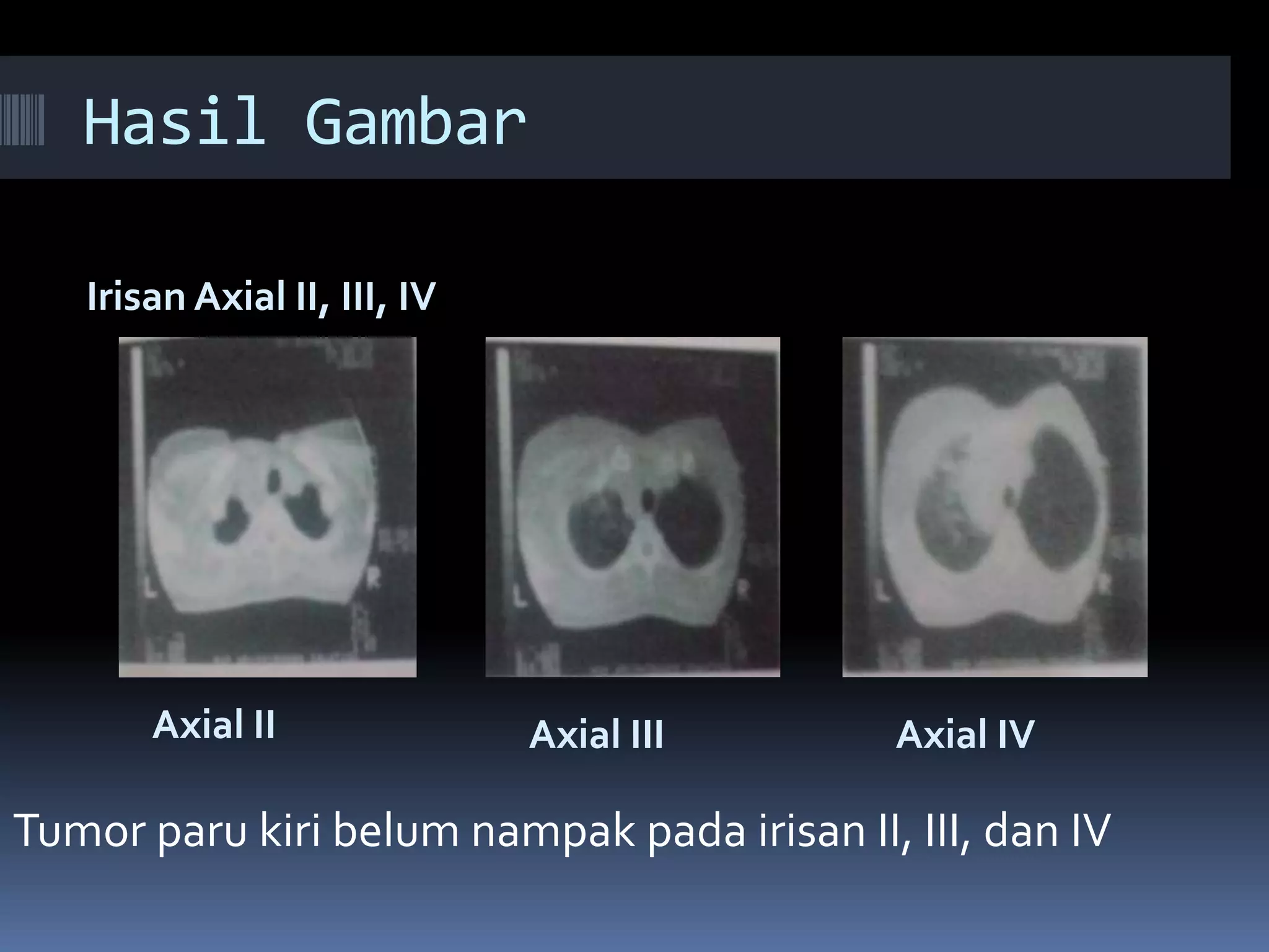 ppt Ct scan thorax pada klinis tumor hepar | PPTX