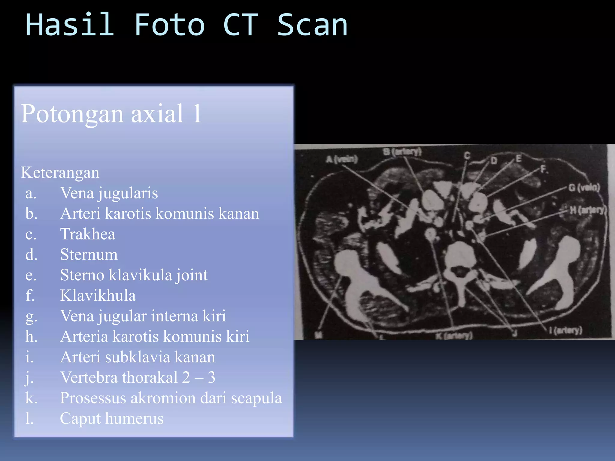 ppt Ct scan thorax pada klinis tumor hepar | PPTX