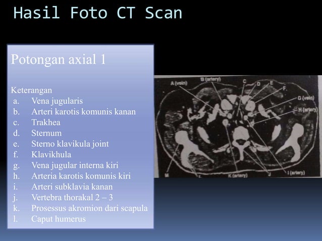 ppt Ct scan thorax pada klinis tumor hepar | PPT