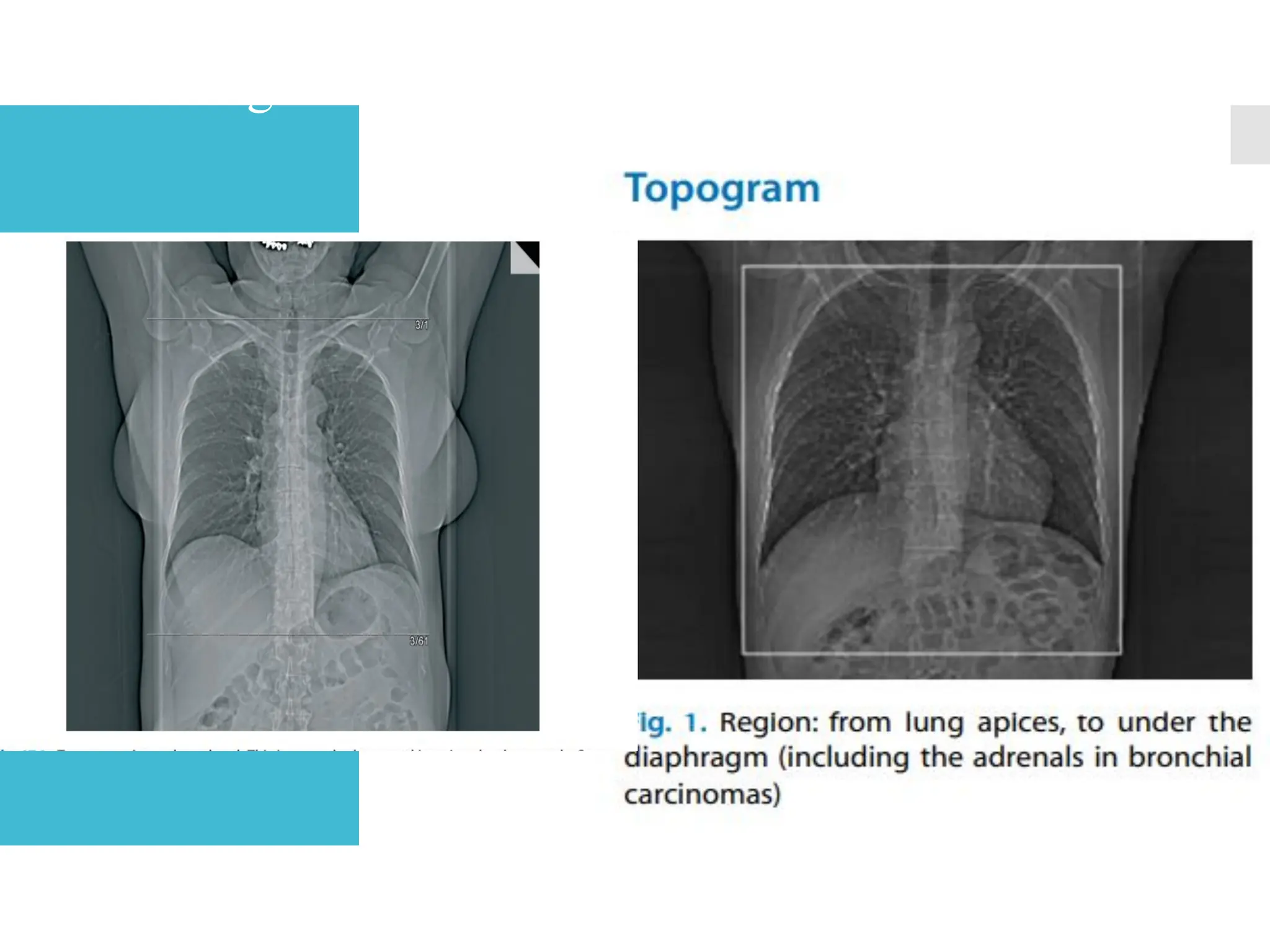 CT SCAN THORAX.pdf