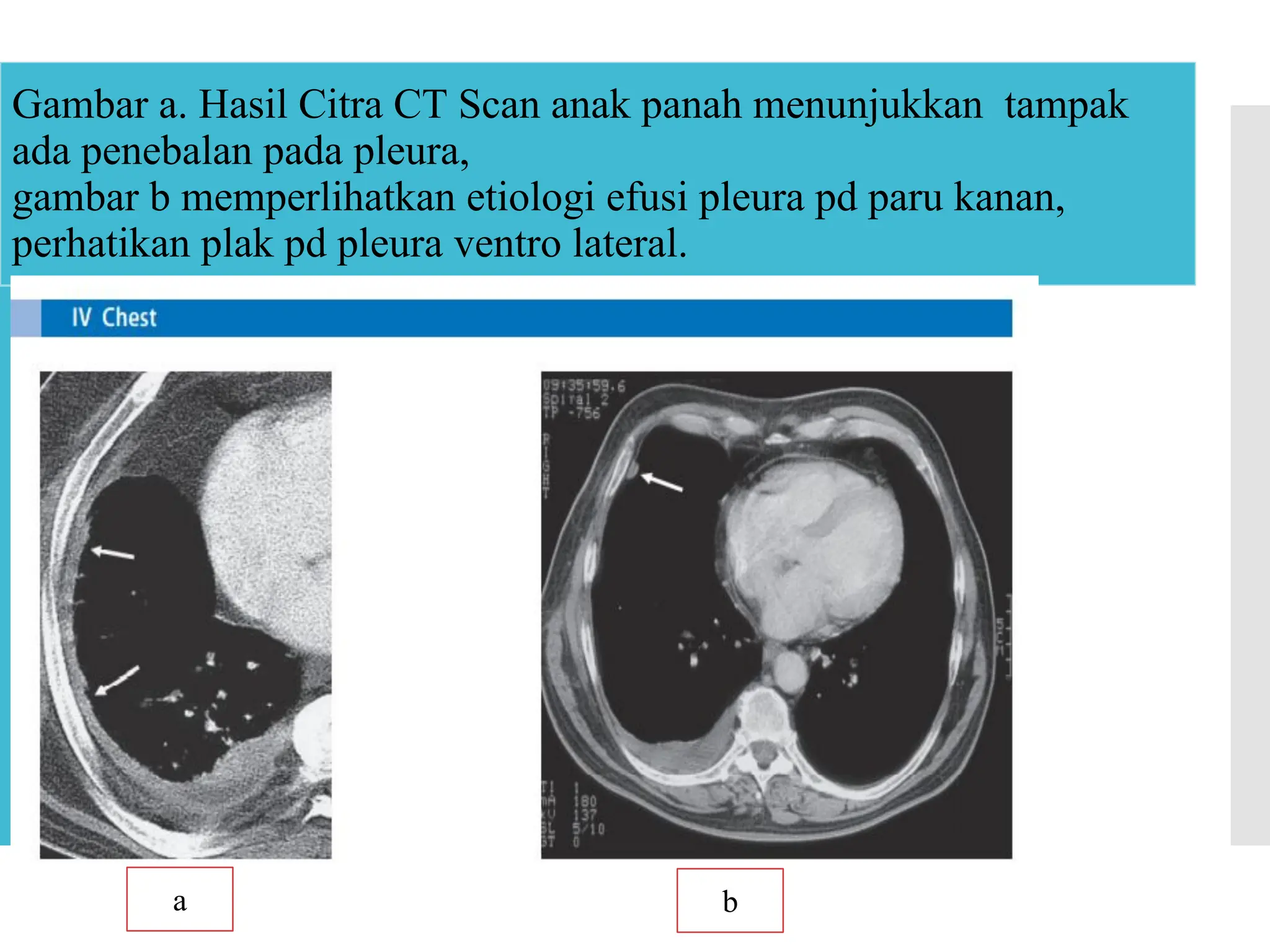 CT SCAN THORAX.pdf