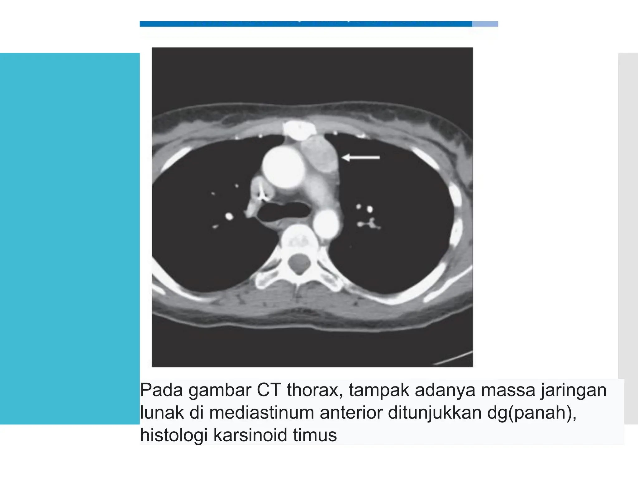 CT SCAN THORAX.pdf