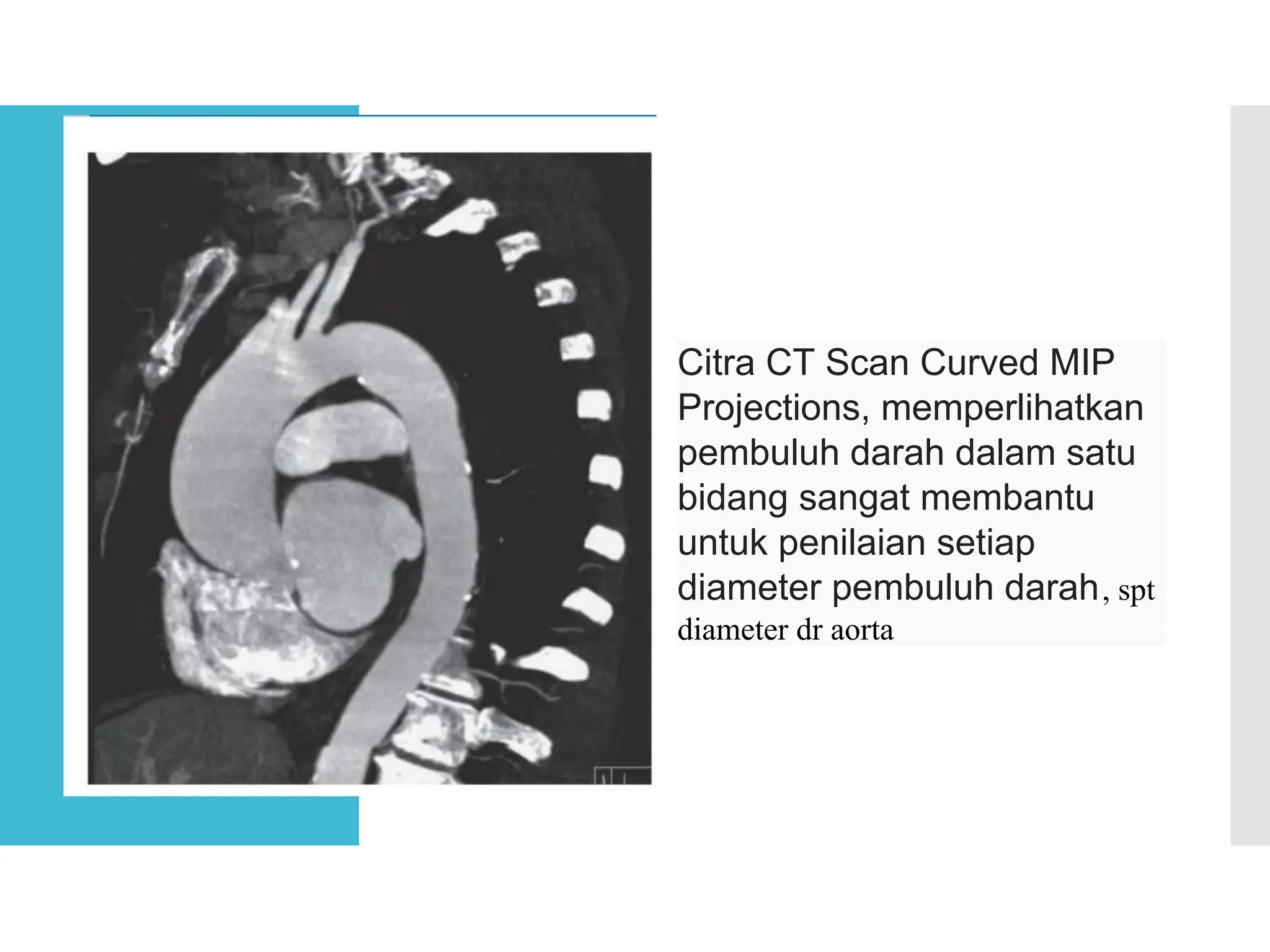 CT SCAN THORAX.pdf